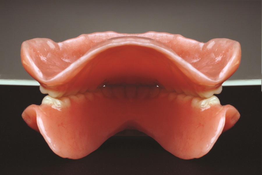 Utilizing Lingualized Posterior Occlusion – Mid-Continental Dental Supply